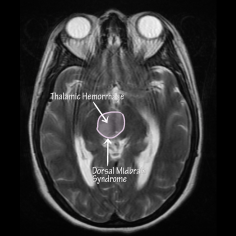 Neuroanatomy: Abnormal Pupils | ditki medical & biological sciences