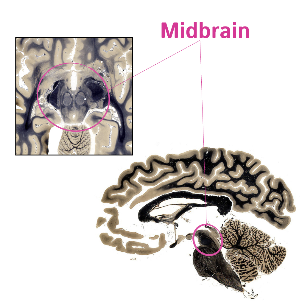 Neuroanatomy: Midbrain Syndromes | ditki medical & biological sciences