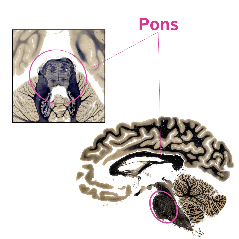 Neuroanatomy: Pontine Syndromes | ditki medical & biological sciences