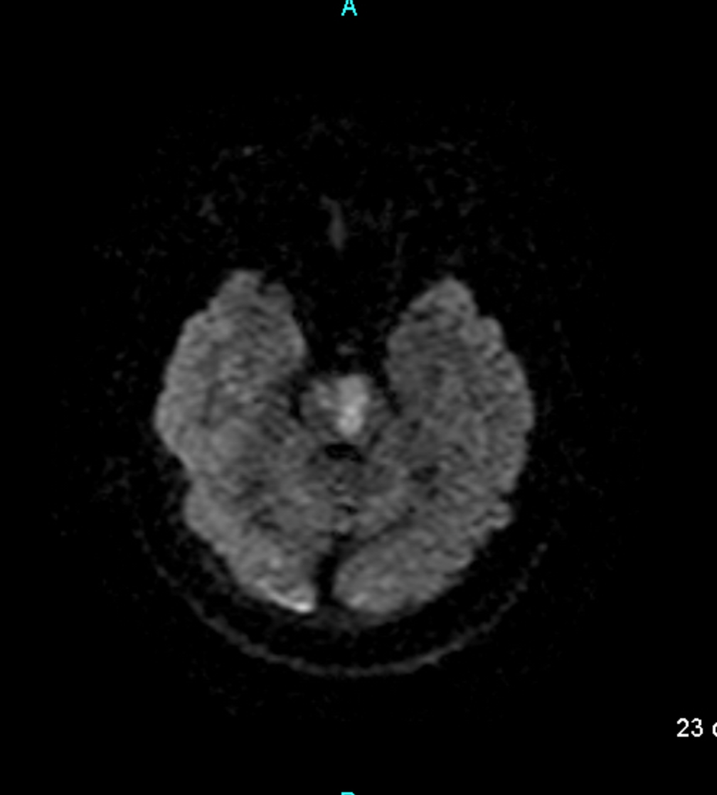Neuroanatomy: Pontine Syndromes | ditki medical & biological sciences