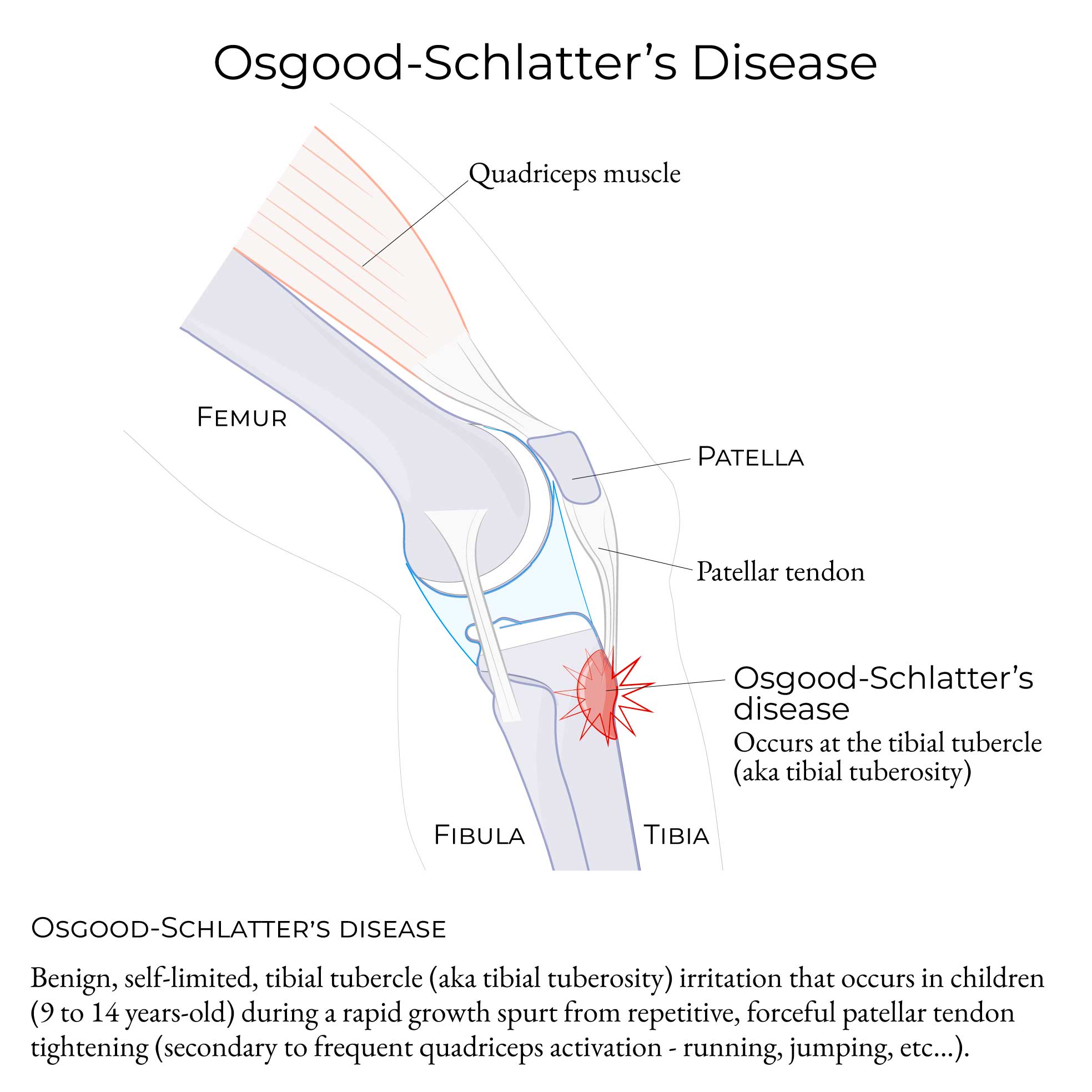 Clinical Pathology: Childhood-Onset Bone Diseases | ditki medical ...